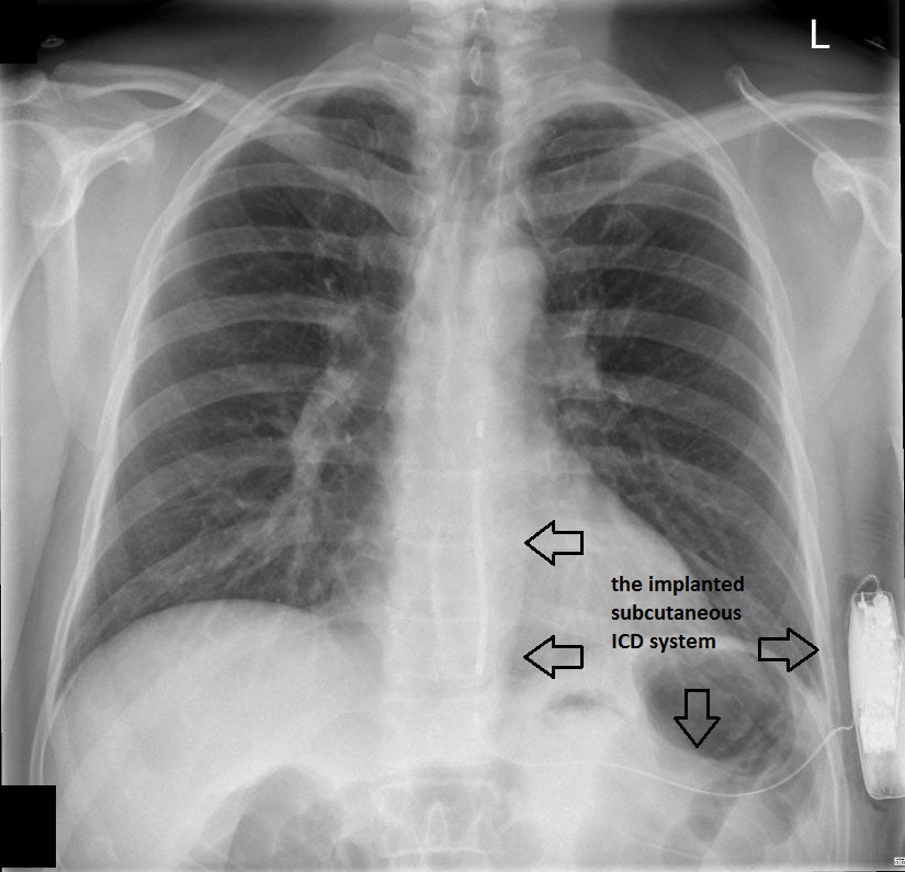 Icd 10 Cm Code For Lump On Chest Icd 10 Cm Code For Lump On Chest